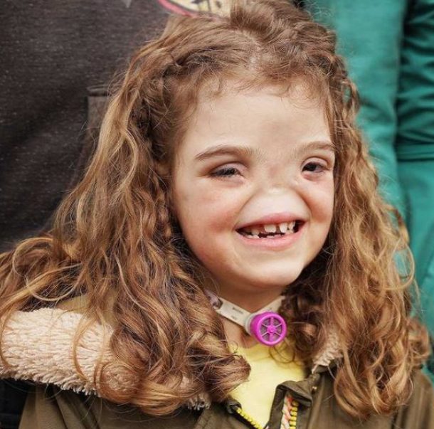 A child without a nose. what the baby has to go through and how she ...
