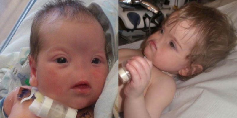 A child without a nose. what the baby has to go through and how she ...